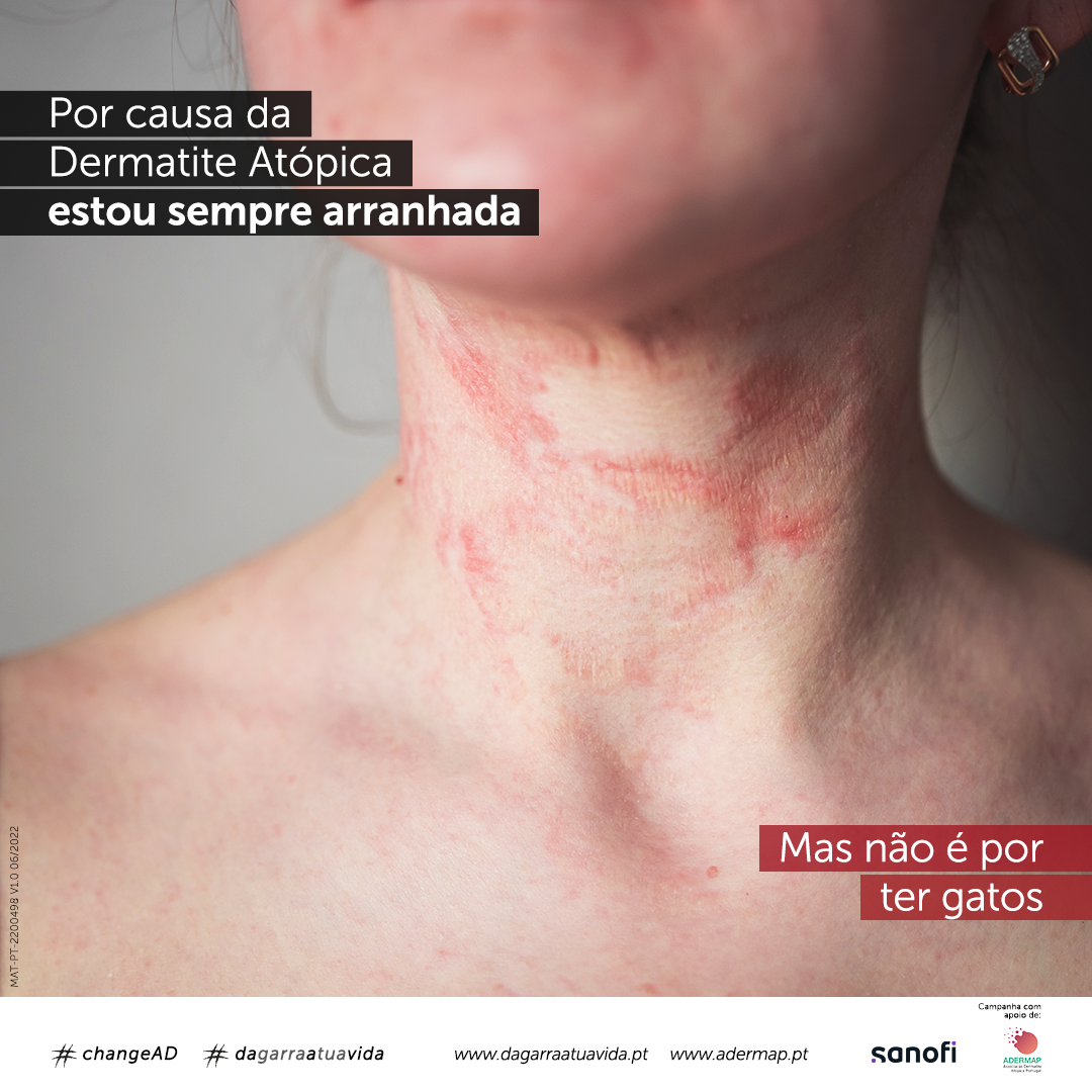 Campanha alerta para consequências físicas e emocionais da dermatite ...