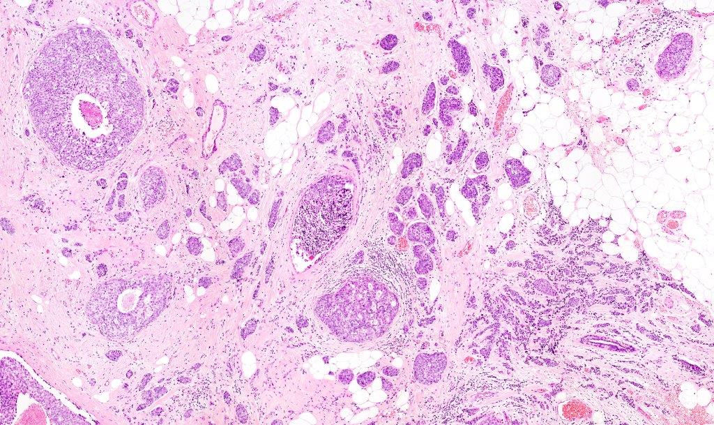 Tratamento experimental cura mulher com cancro da mama em estado ...