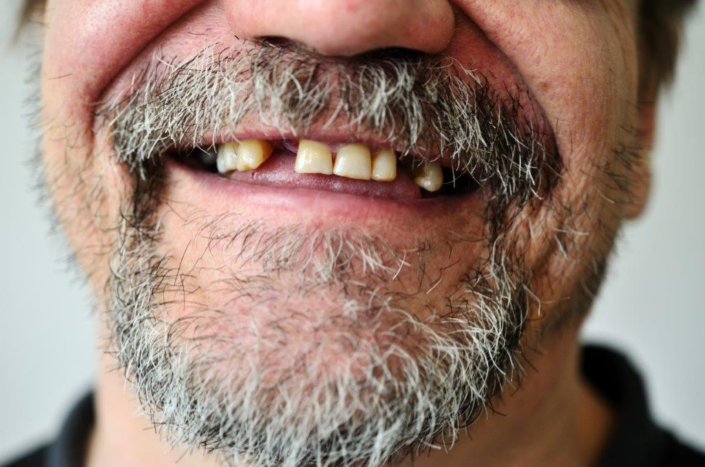 Mais de 70% dos portugueses têm falta de dentes | Atlas da Saúde