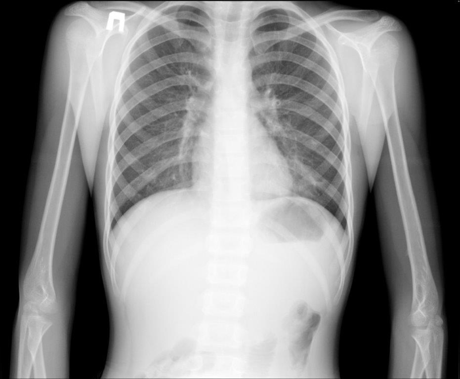 Diagnóstico da tuberculose demora mais de cem dias desde o início dos ...